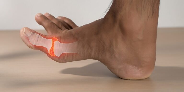 Stages of Gout: How the Disease Progresses Over Time